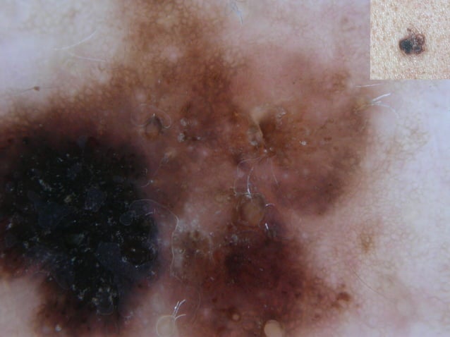 Lesion on the back 2013 | PPT | Skin and Dermatology | Diseases and ...