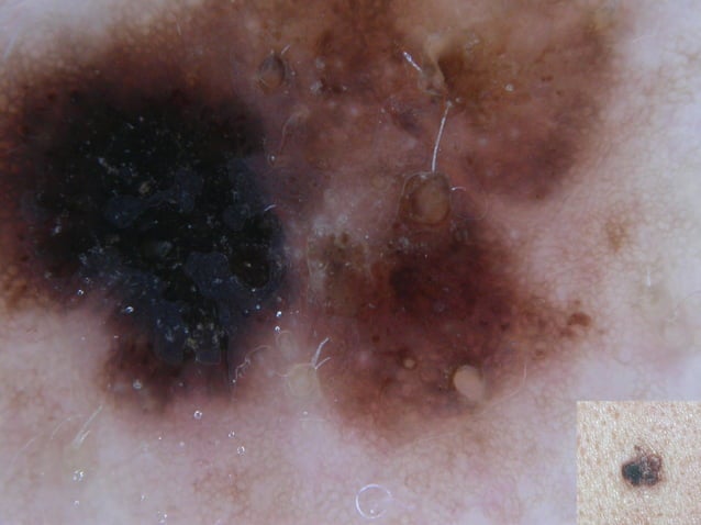 Lesion on the back 2013 | PPT