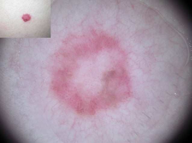 Lesion on the leg. | PPT