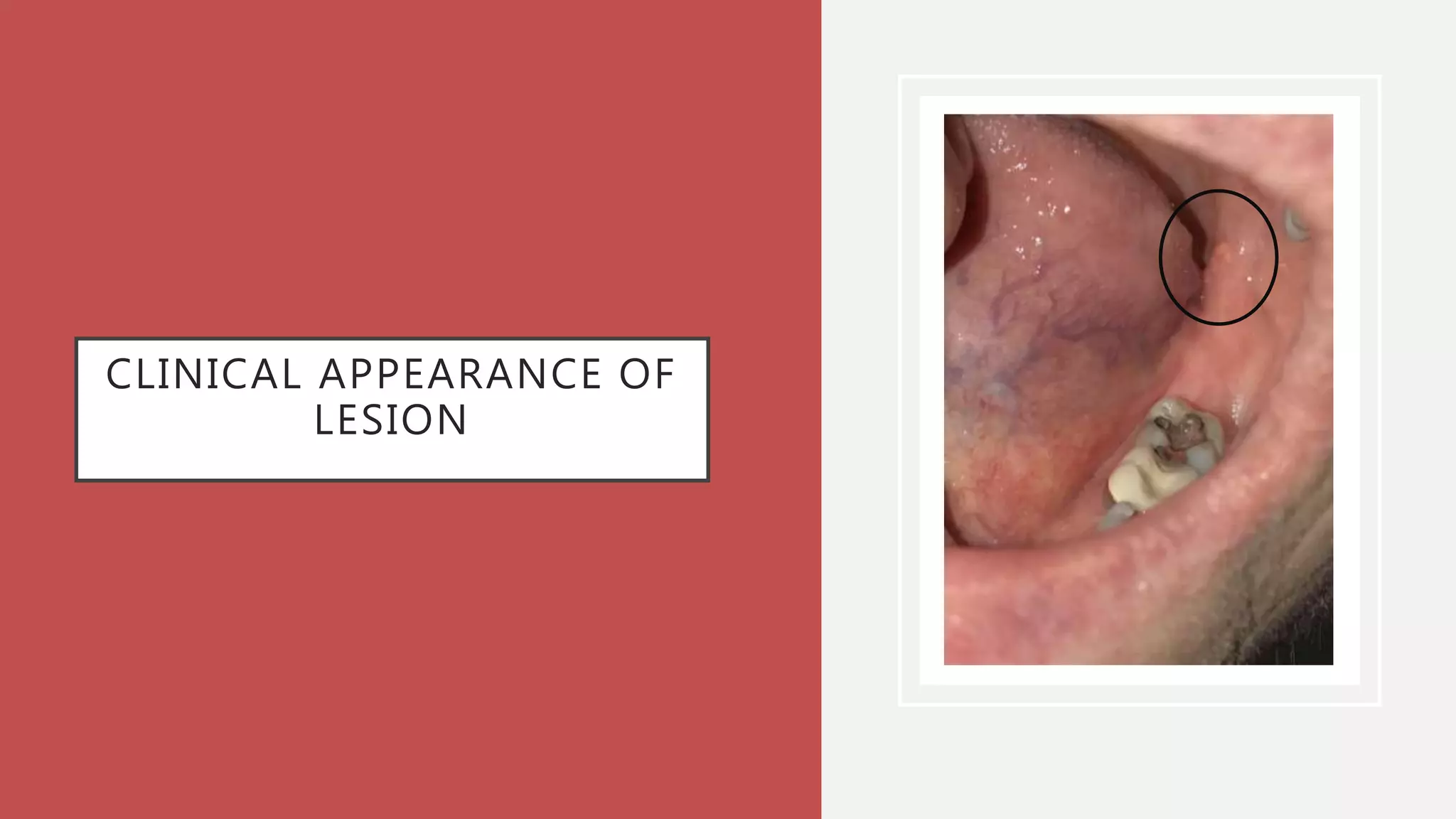 Lesion Presentation | PPTX