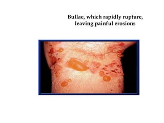 Lesions | PPT
