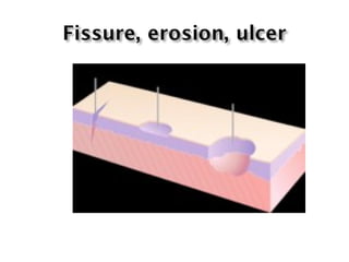 Lesions | PPT | Skin and Dermatology | Diseases and Conditions