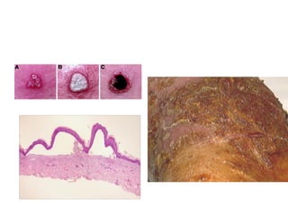 Lesions | PPT