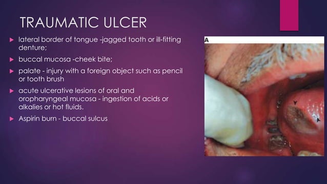 Lesions of oral cavity | PPTX | Dental Health | Diseases and Conditions