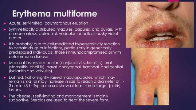 Lesions of oral cavity