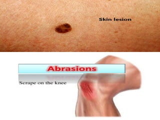 Lesions and abrasions in skin