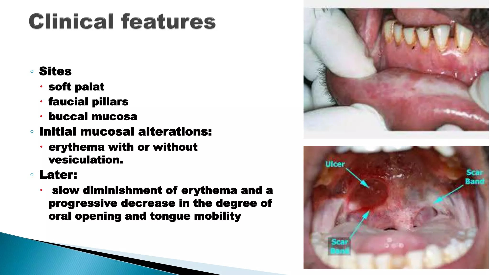 Lesions of oral cavity | PPTX