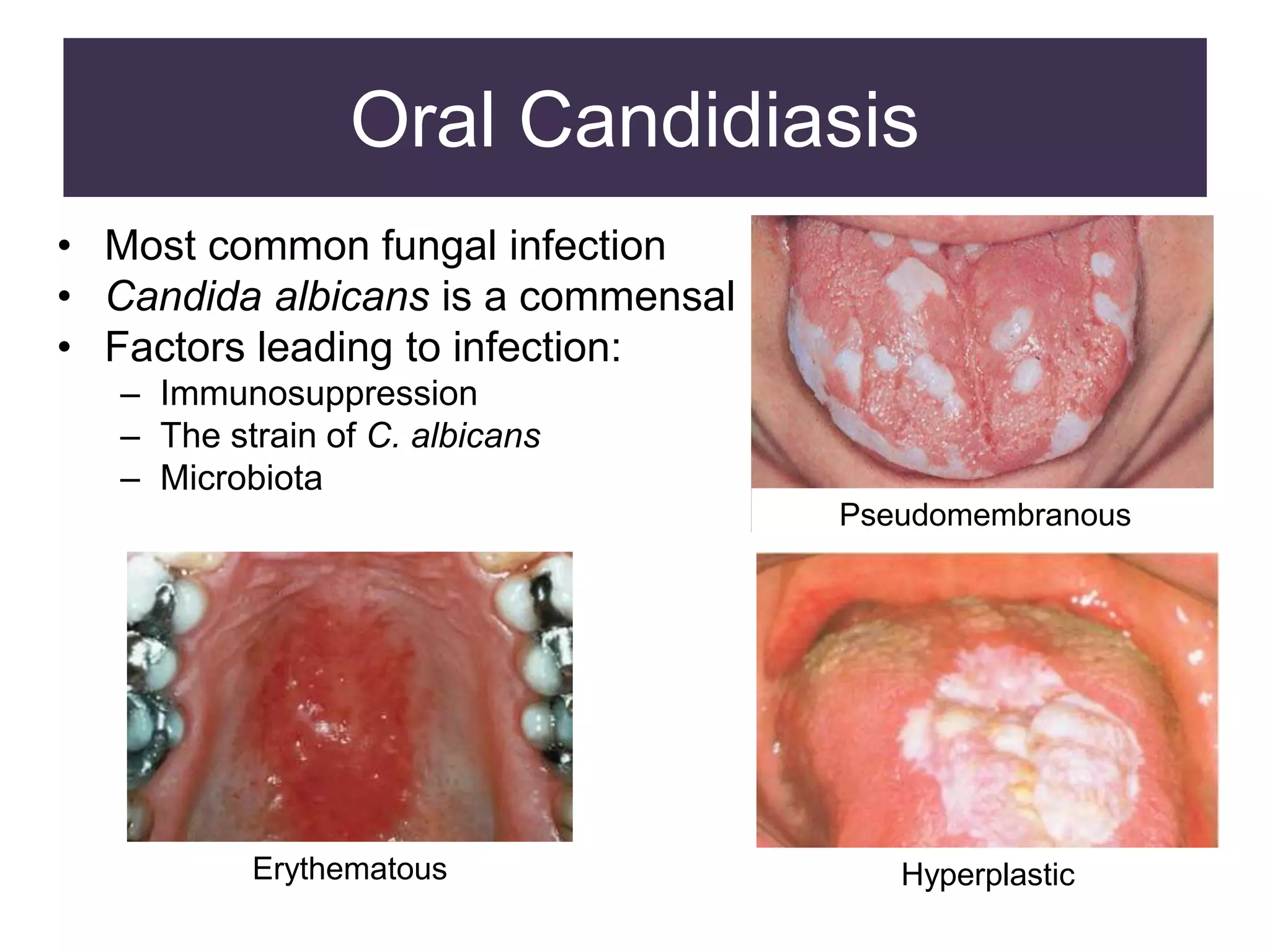 Lesions of oral cavity and salivary gland | PPTX