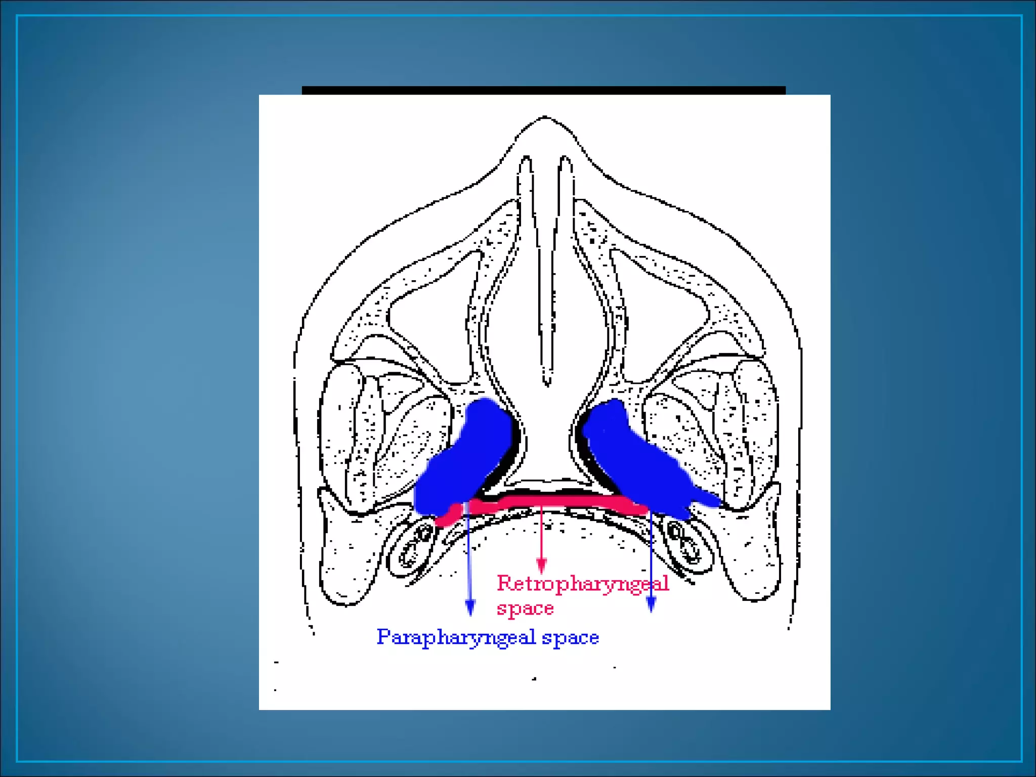Lesions of parapharyngeal region | PPT