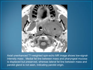 Lesions of parapharyngeal region | PPT