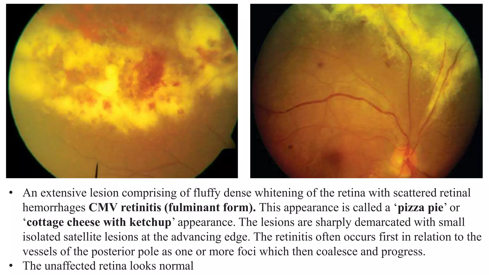 Lesions of retina | PPTX