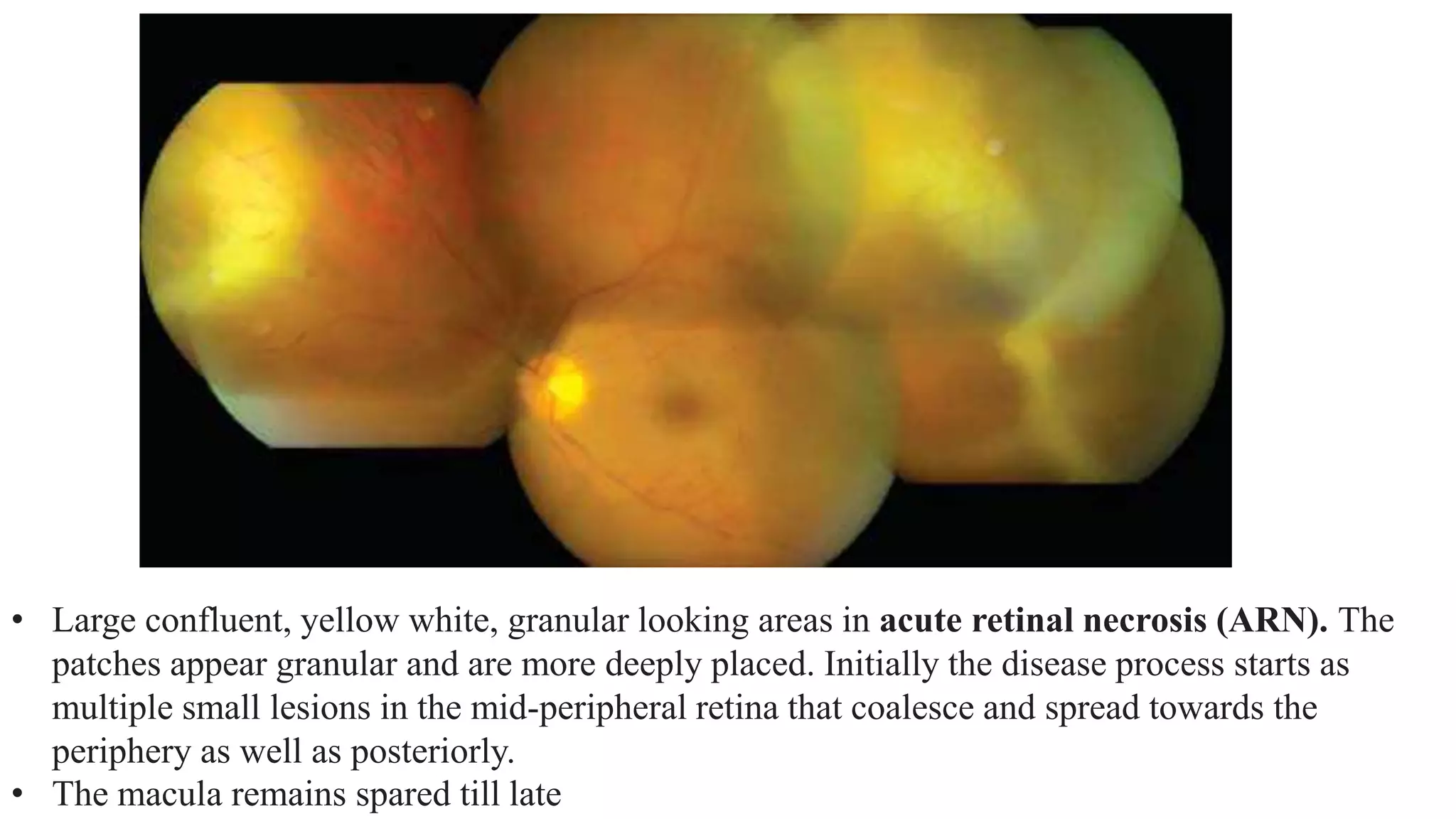 Lesions of retina | PPTX