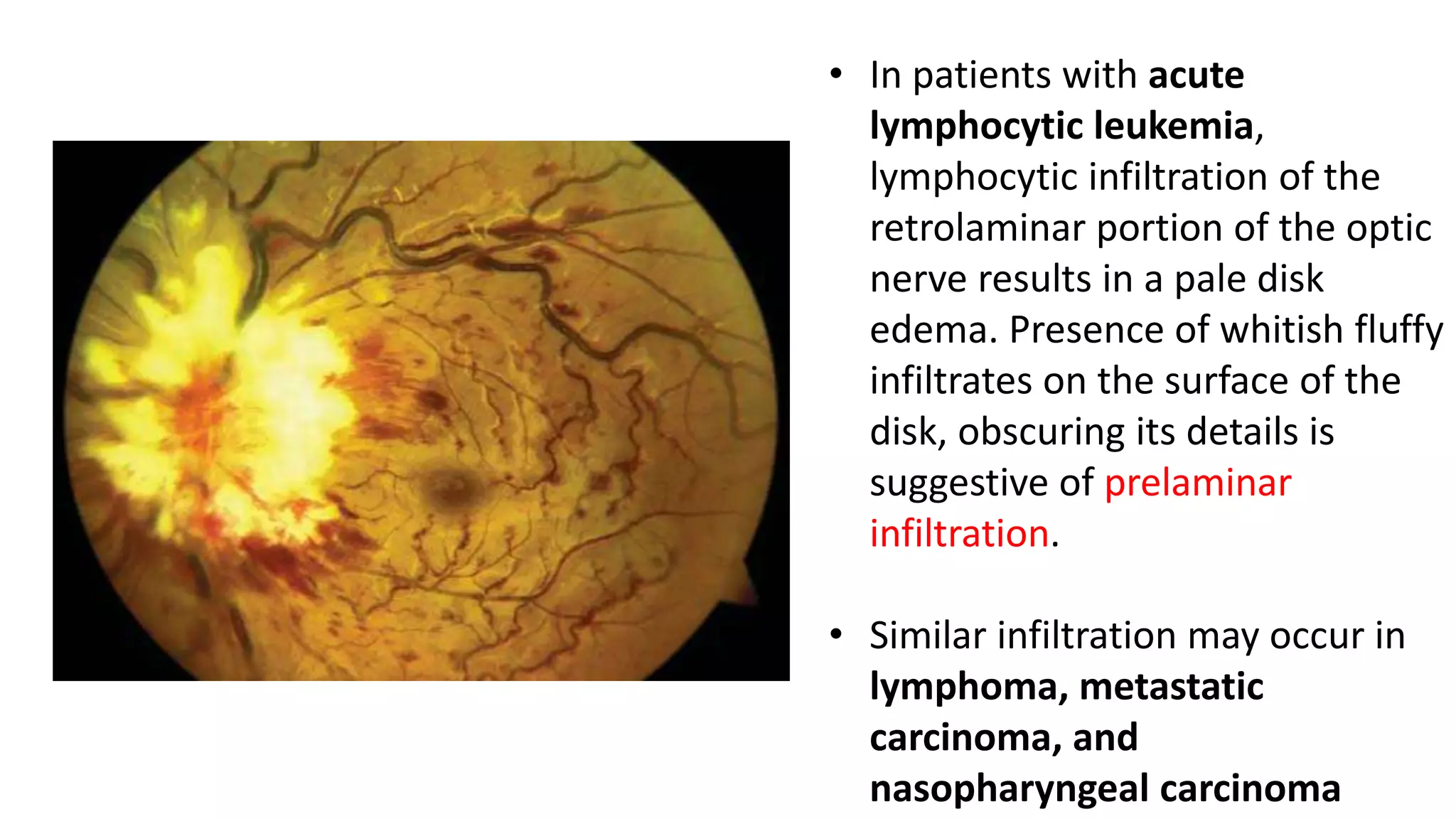 Lesions of retina | PPTX