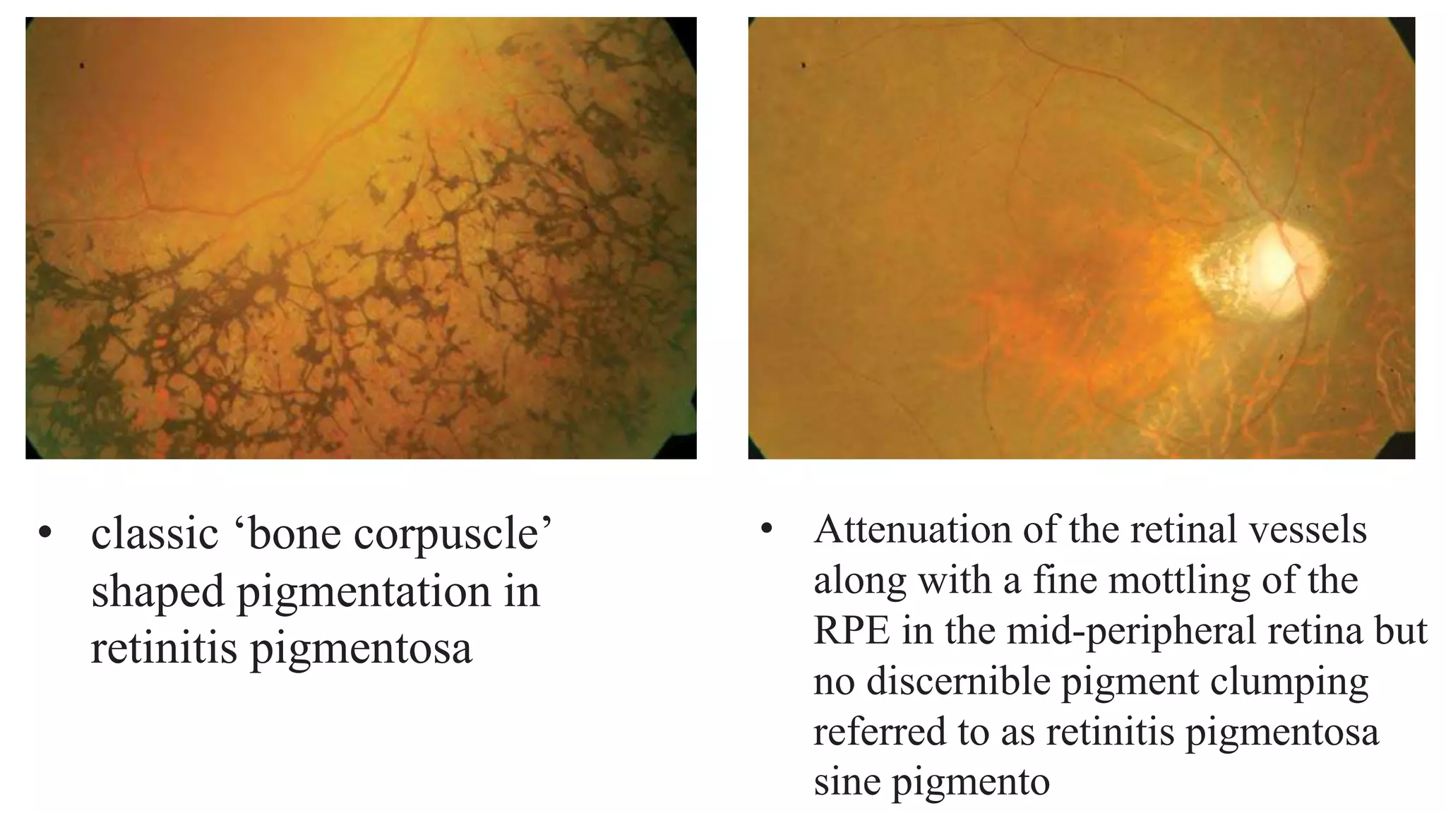 Lesions of retina | PPTX