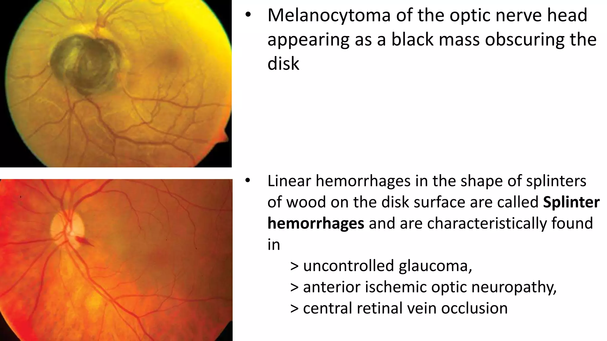 Lesions of retina | PPTX