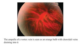Lesions of retina | PPTX