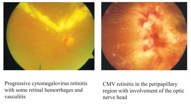 Lesions of retina | PPTX