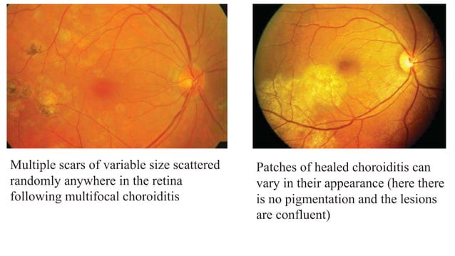 Lesions of retina | PPTX