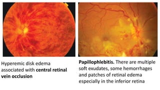 Lesions of retina | PPTX