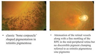 Lesions of retina | PPTX