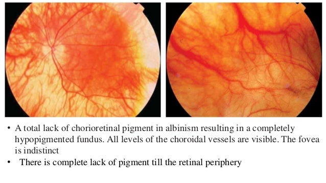 Lesions of retina