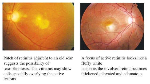 Lesions of retina