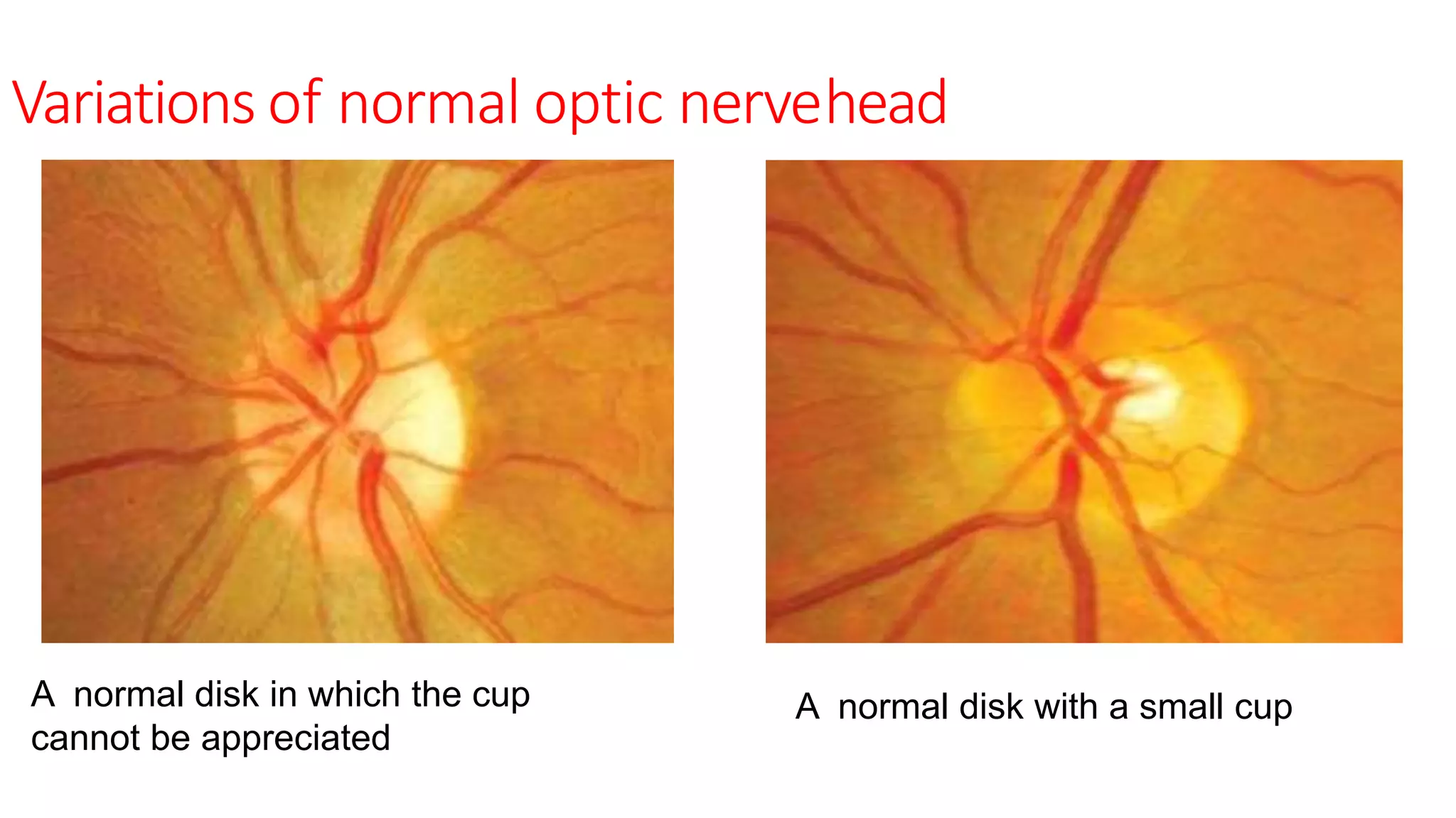 Lesions of retina | PPTX