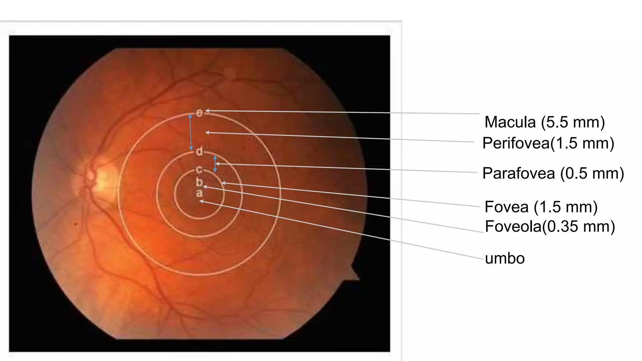 Lesions of retina | PPTX | Eye and Vision Conditions | Diseases and ...