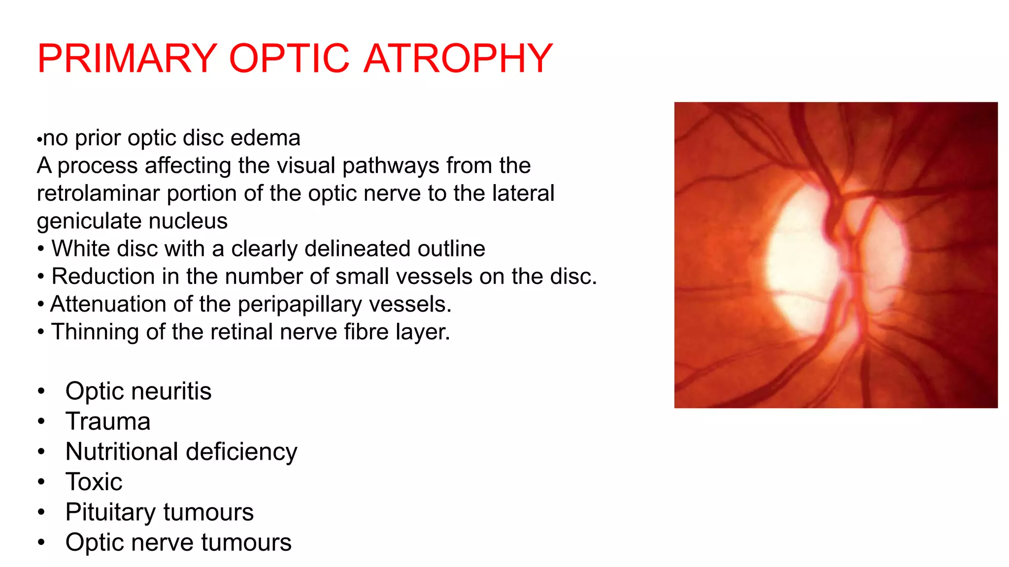 Lesions of retina | PPTX