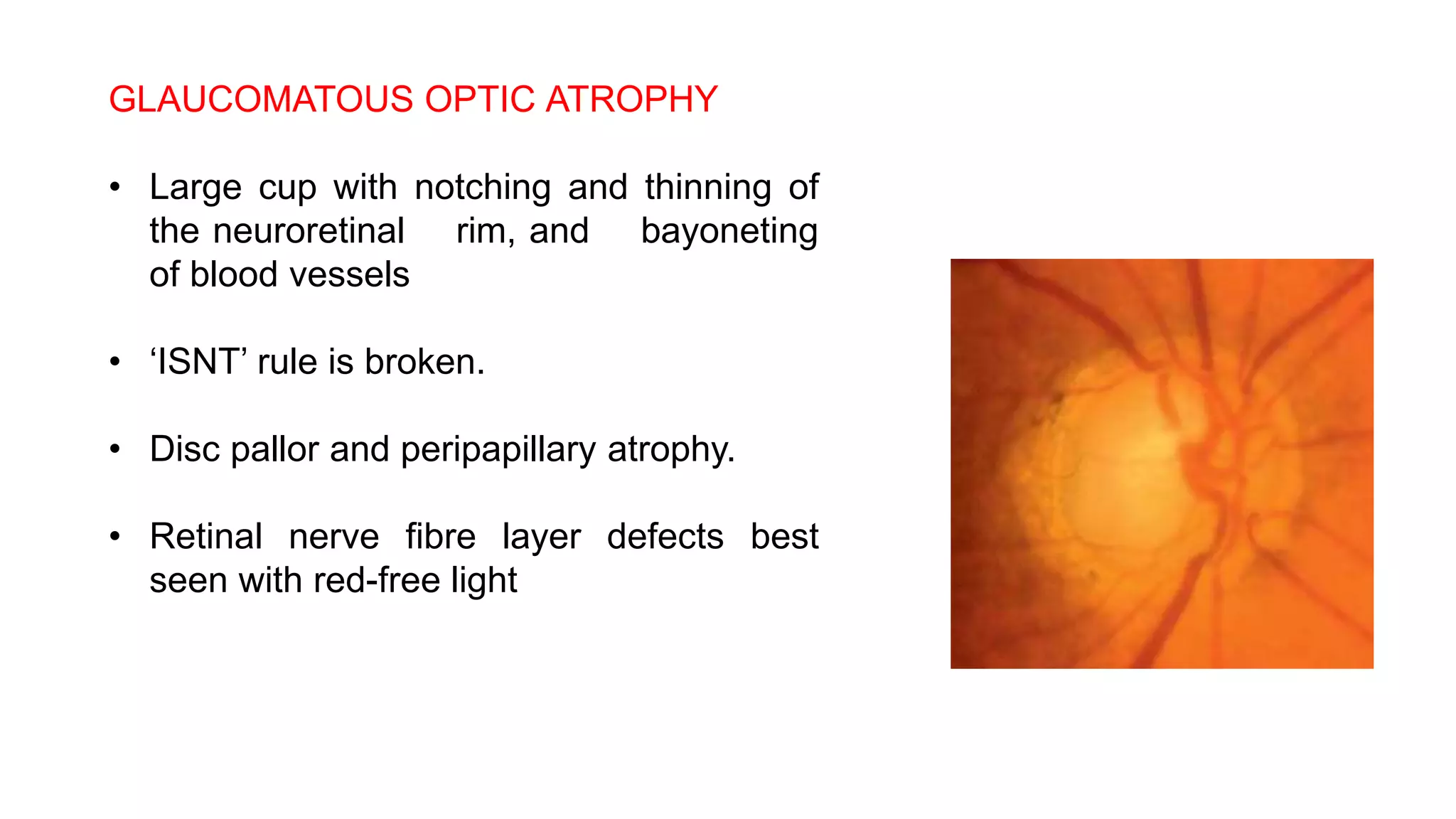 Lesions of retina | PPTX