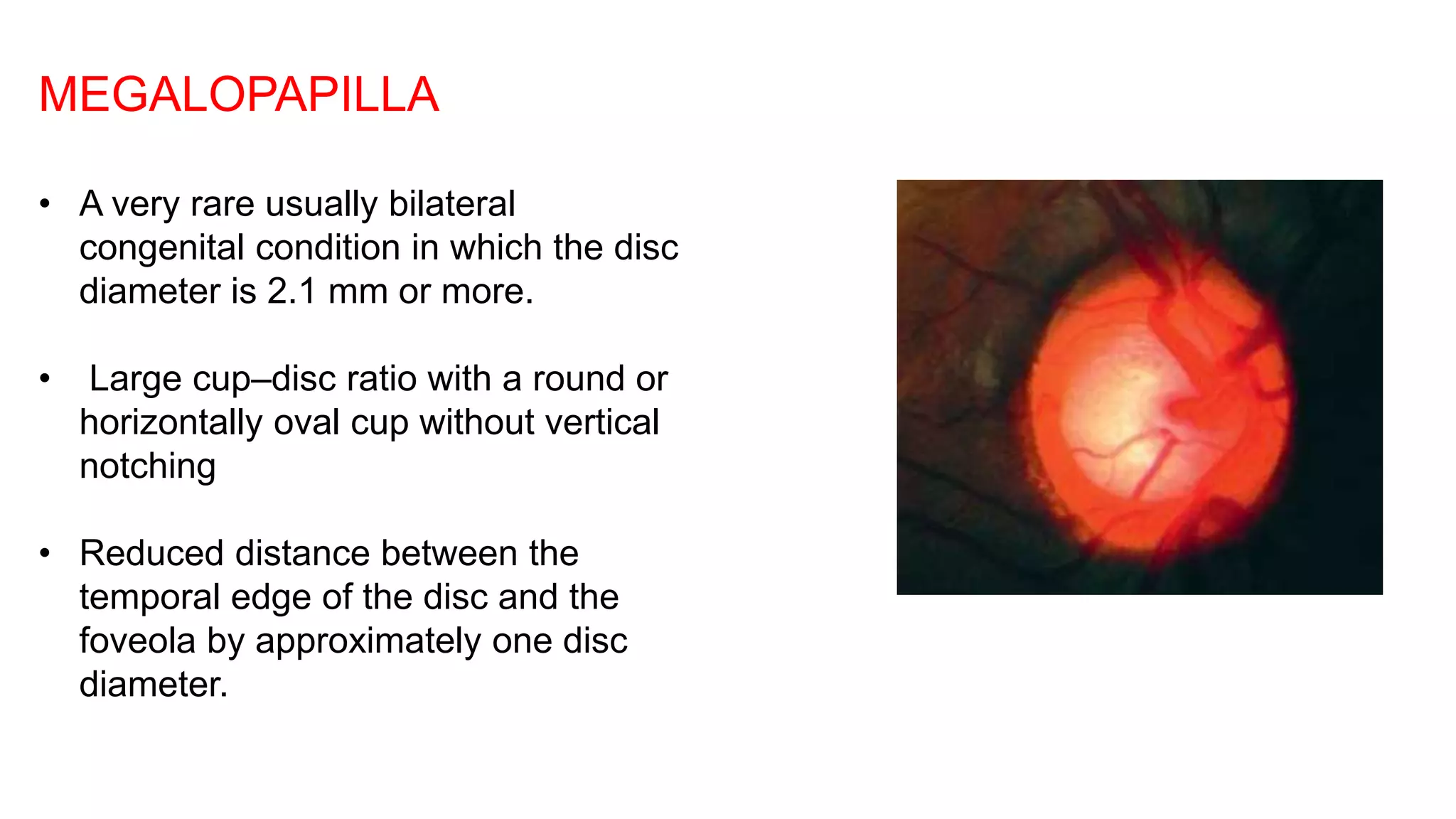 Lesions of retina | PPTX
