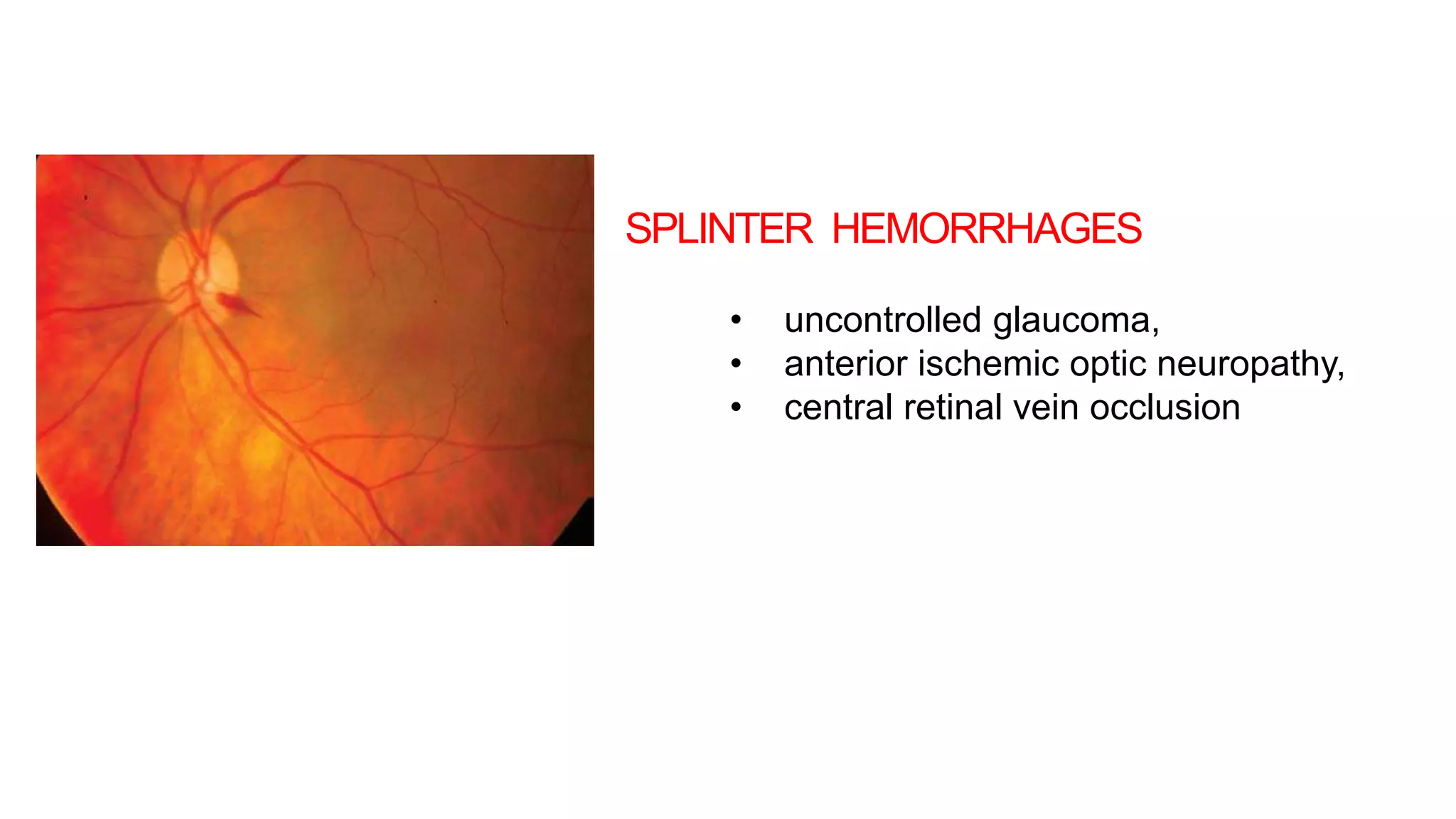 Lesions of retina | PPTX