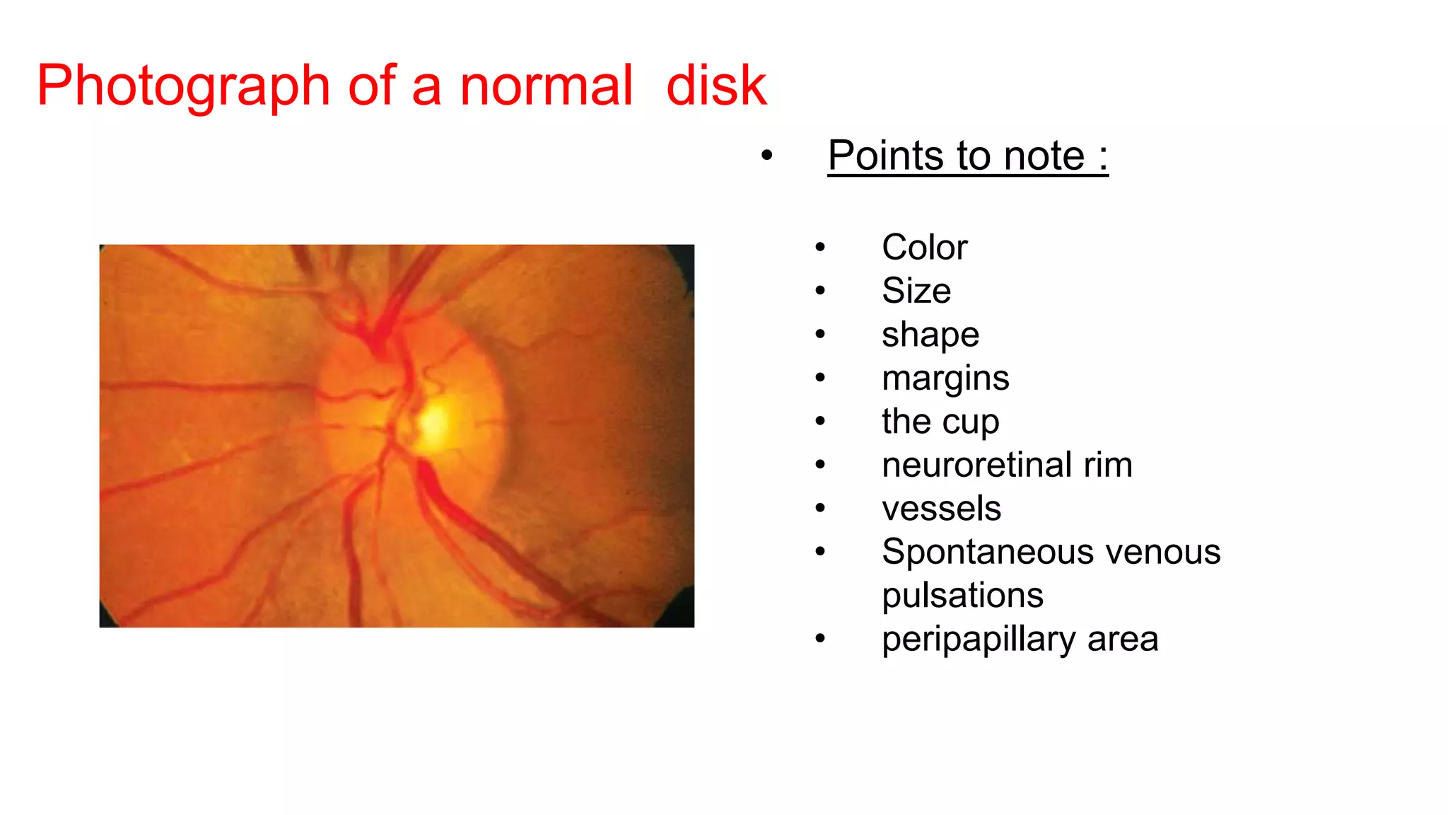 Lesions of retina | PPTX