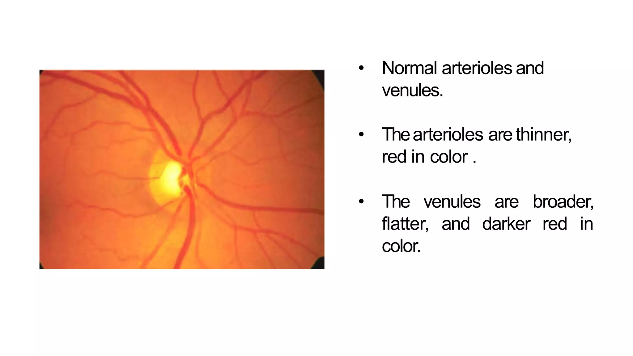 Lesions of retina | PPTX