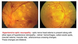 Lesions of retina | PPTX
