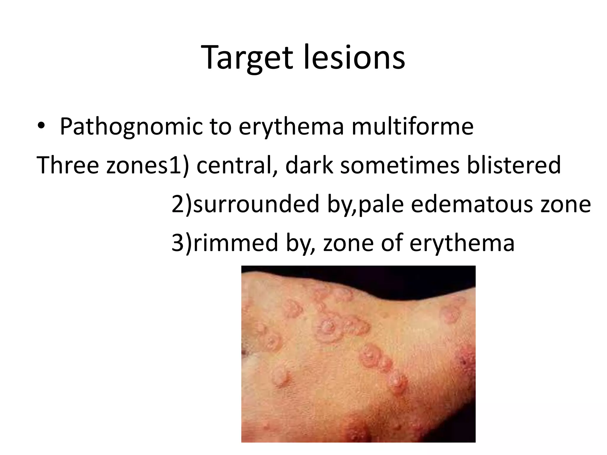 Lesions of skin | PPTX