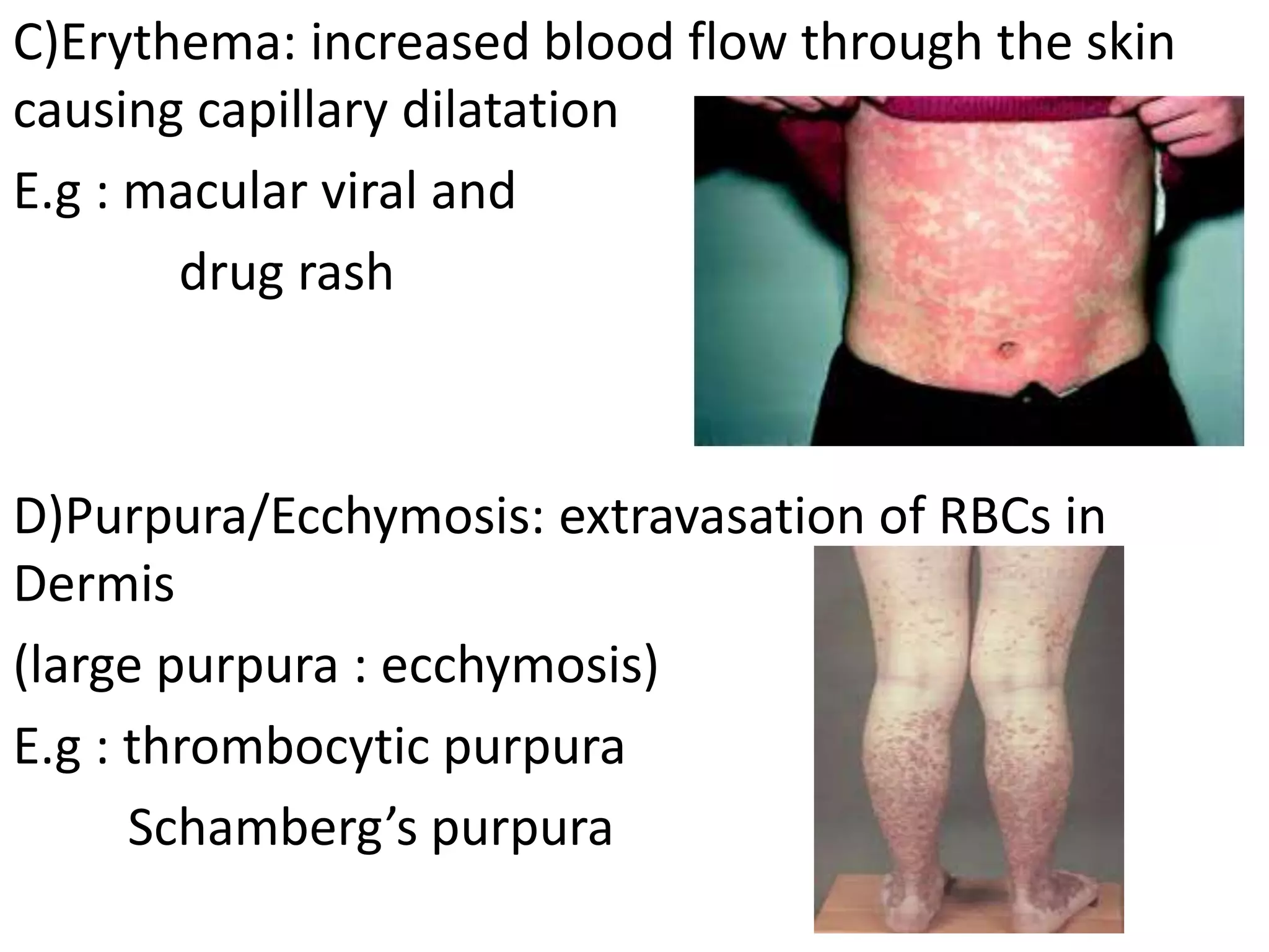 Lesions of skin | PPTX