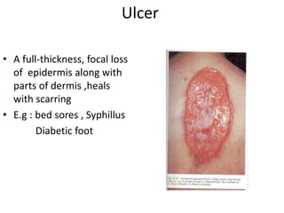 Erosion Skin Vs Ulcer