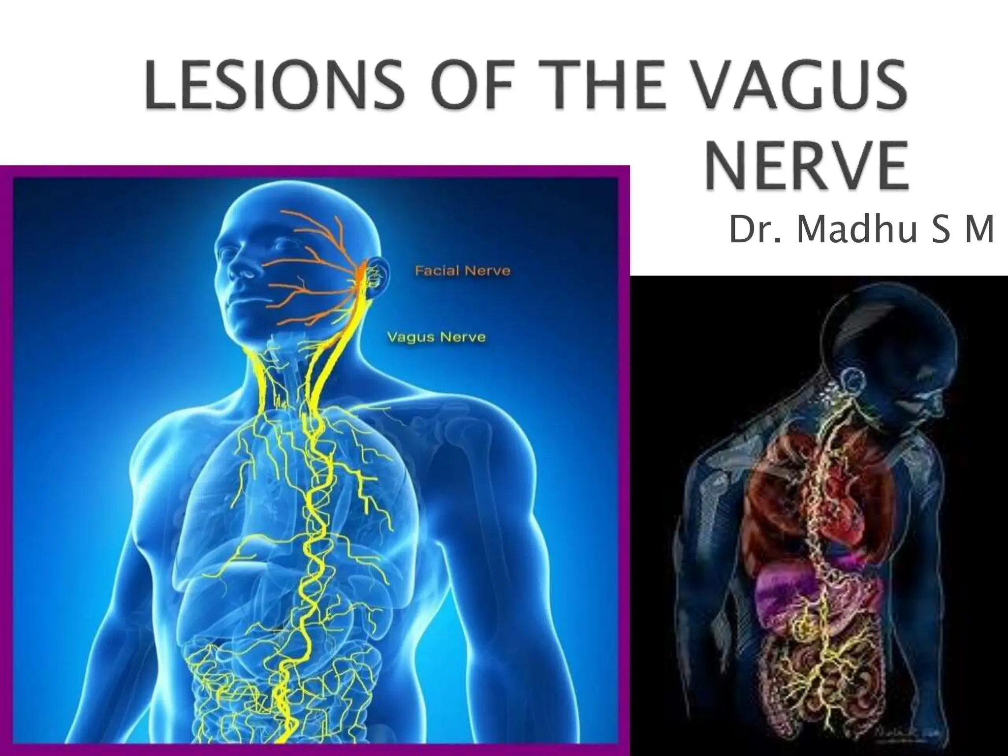 LESIONS OF THE VAGUS NERVE.ppt..........x | PPTX