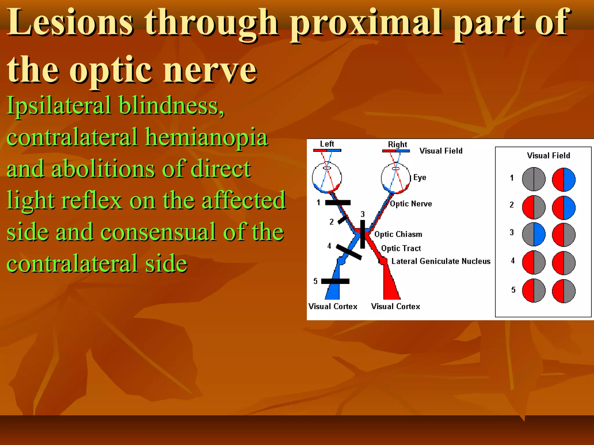 Lesions of the visual pathway | PPT
