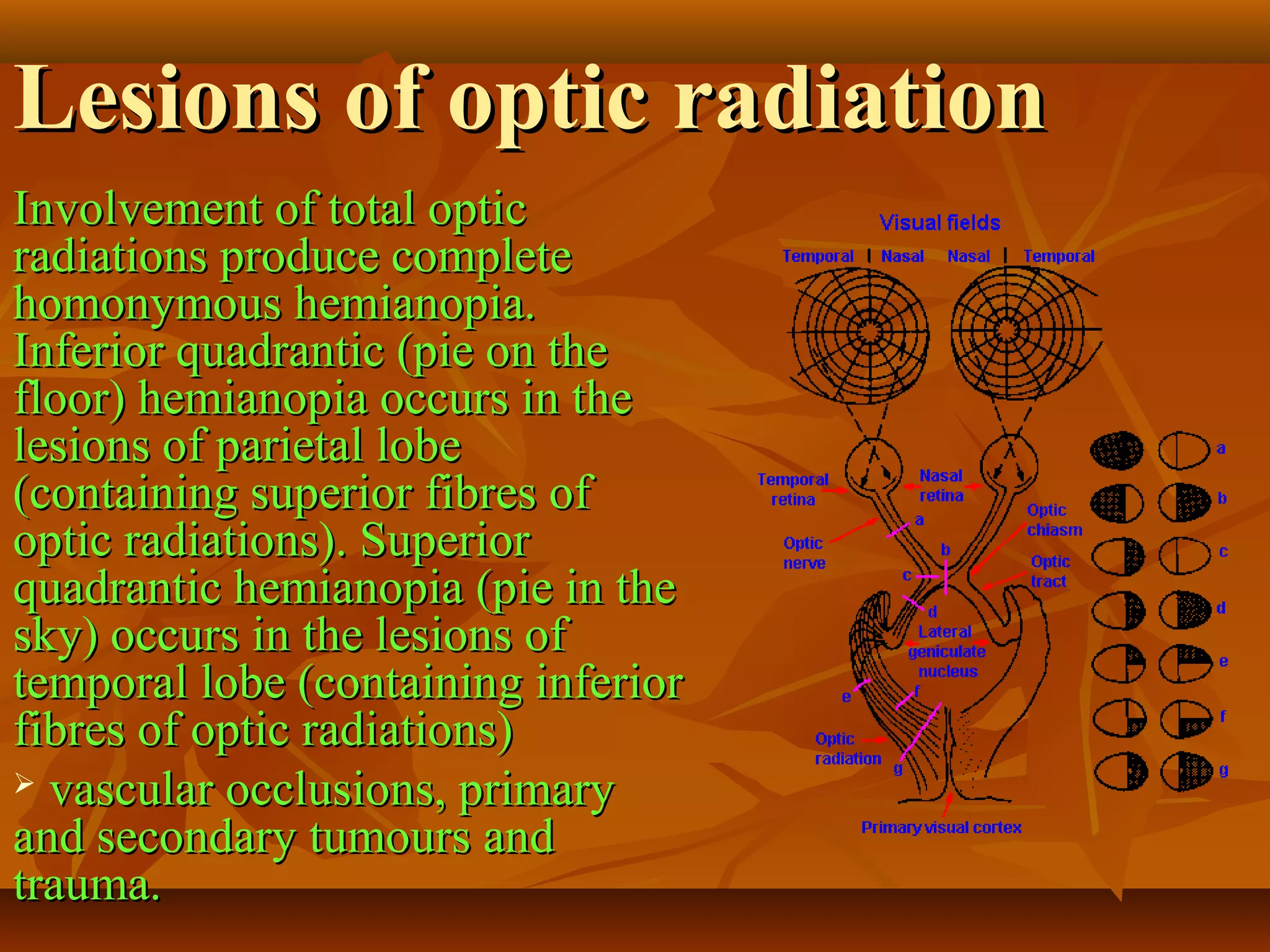 Lesions of the visual pathway | PPT