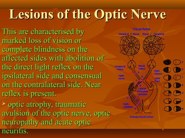 Lesions of the visual pathway | PPT | Eye and Vision Conditions ...