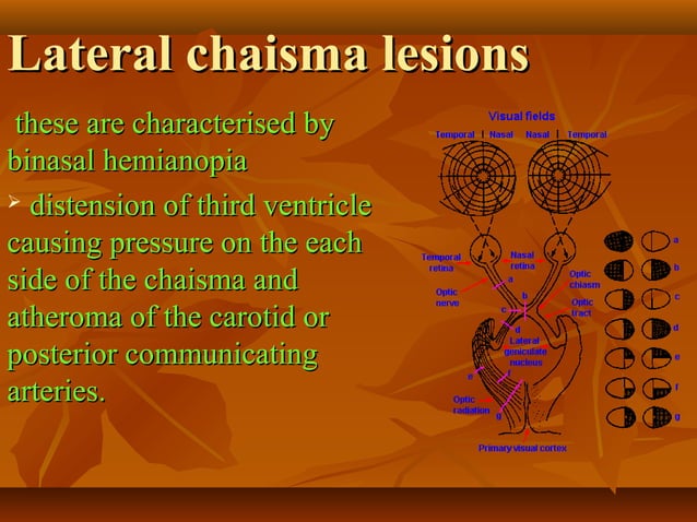 Lesions of the visual pathway | PPT | Eye and Vision Conditions ...