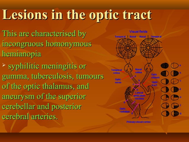 Lesions of the visual pathway | PPT | Eye and Vision Conditions ...