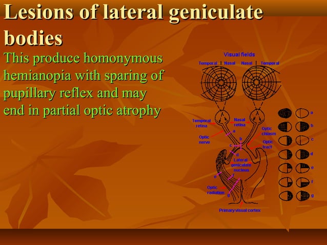 Lesions of the visual pathway | PPT | Eye and Vision Conditions ...
