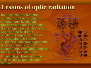 Lesions of the visual pathway | PPT