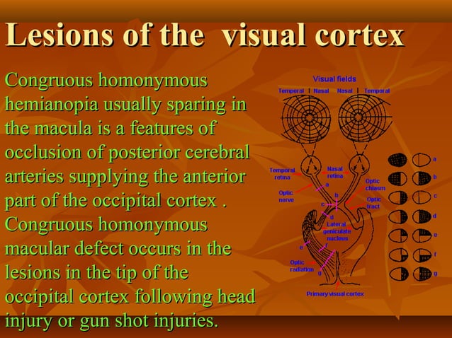 Lesions of the visual pathway | PPT | Eye and Vision Conditions ...