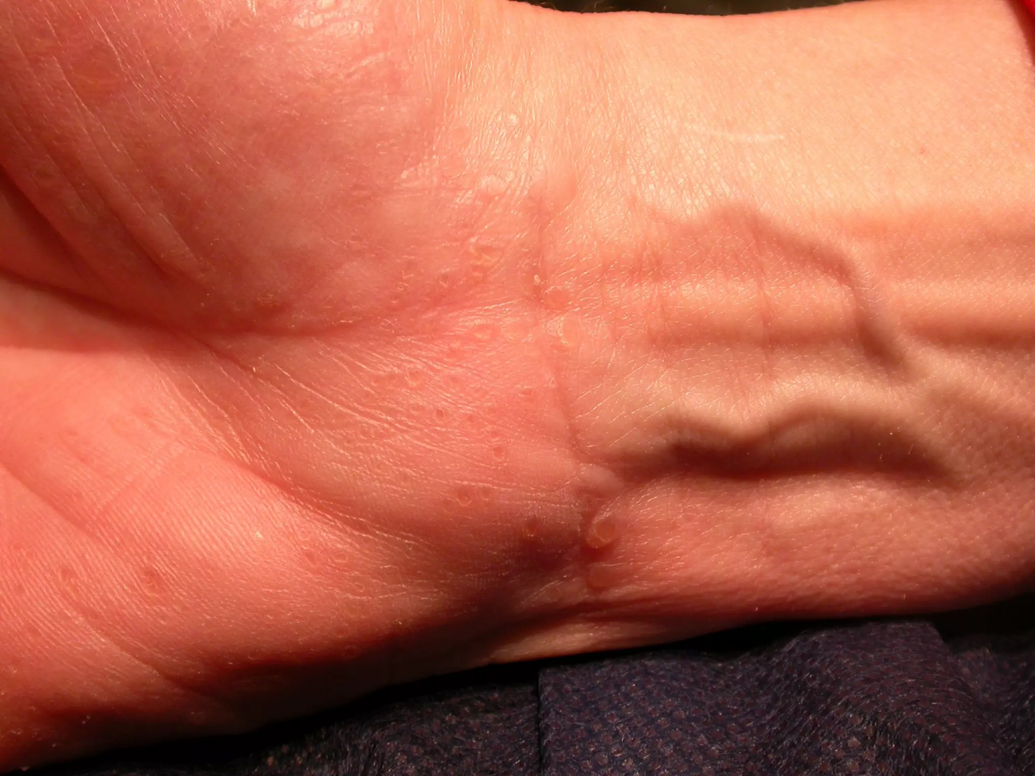 Lesions on the hands | PPT