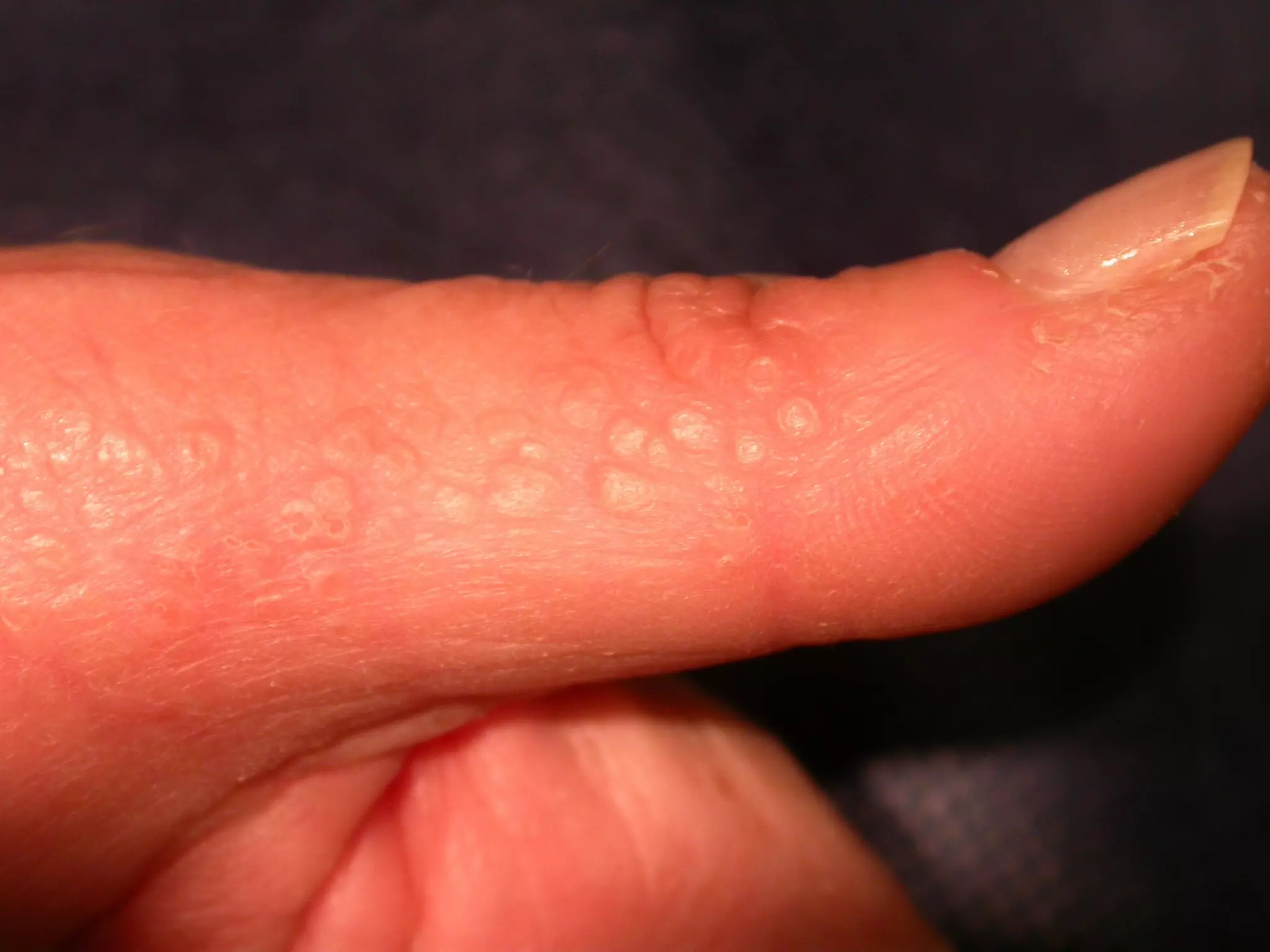 Acrokeratosis verruciformis | PPT