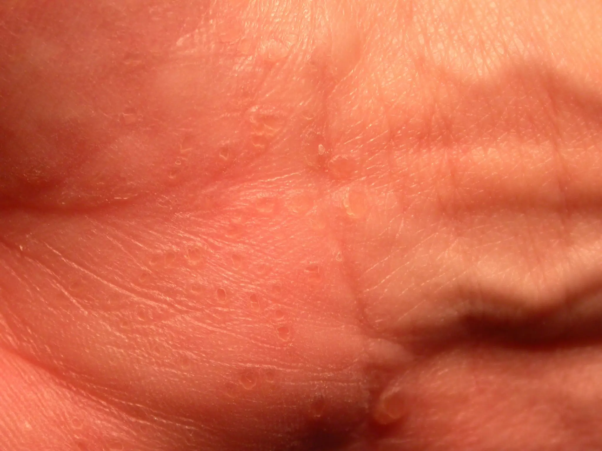 Acrokeratosis verruciformis | PPT